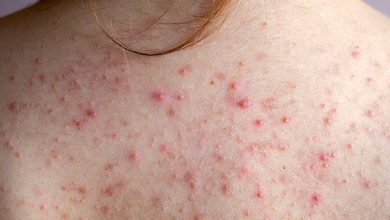 Back Acne (Bacne): Types, Symptoms, Causes & Why Vitastem Ultra is The ...